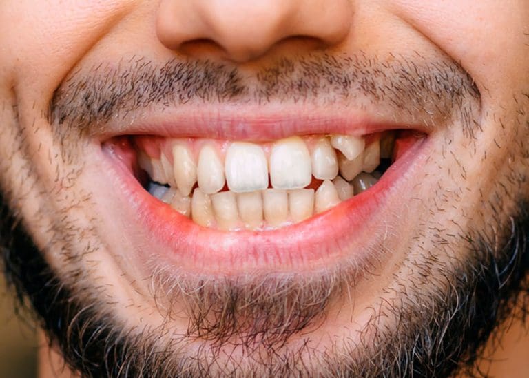 Discoloured Teeth Treatment | The Laser Club