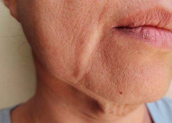 Sagging Jowls Treatment | The Laser Club