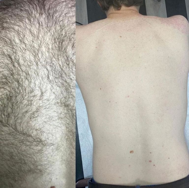 How Does Hair Removal Work for Men