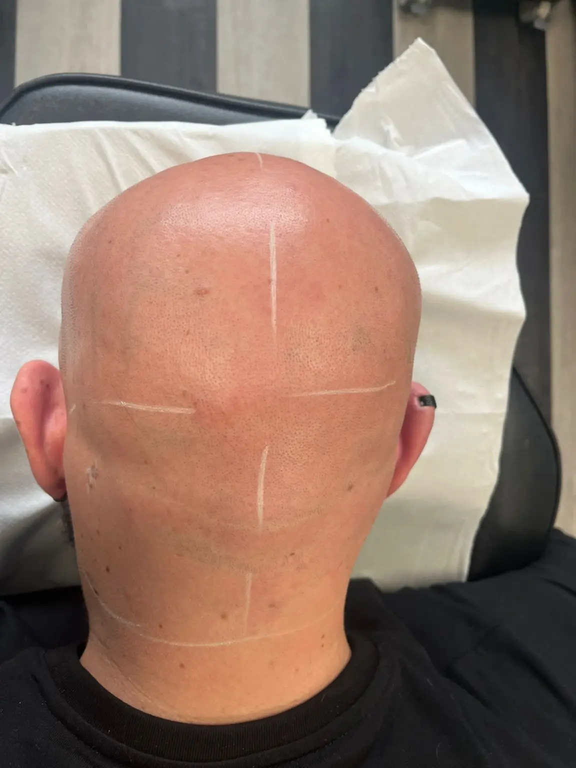 Scalp laser hair removal for baldy or balding men vs scalp ...