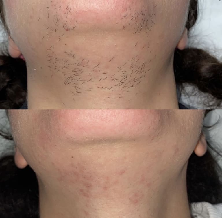 How laser hair removal can help PCOS