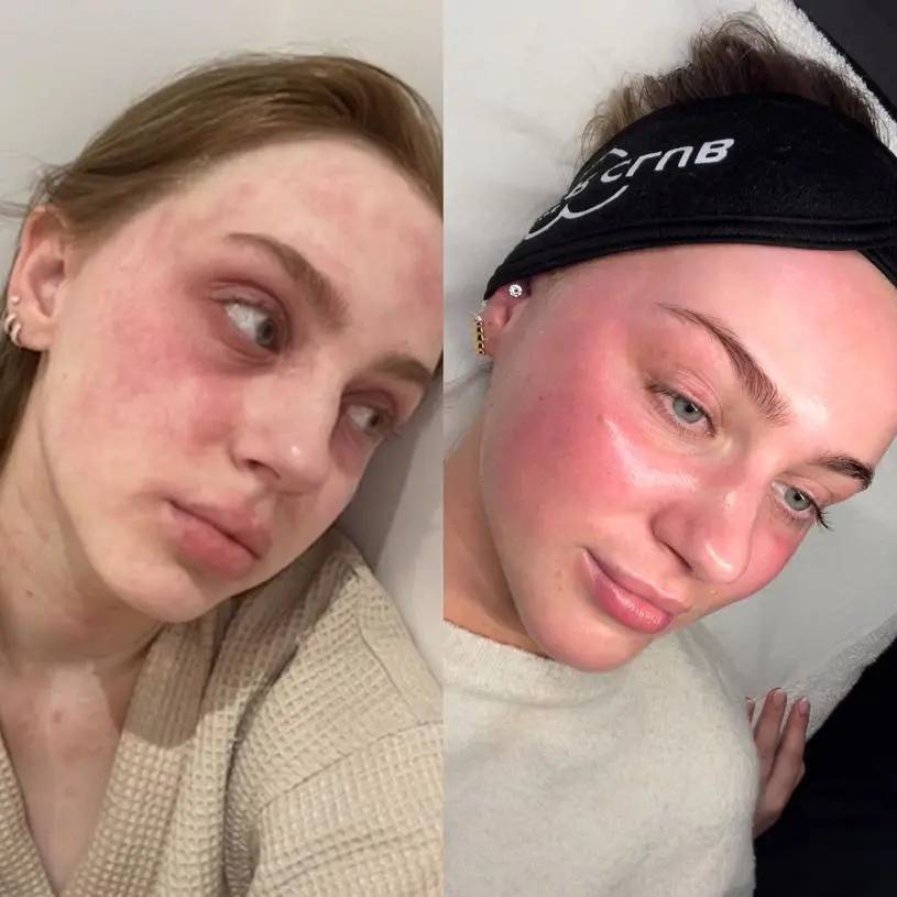 Peel Season Is Upon Us