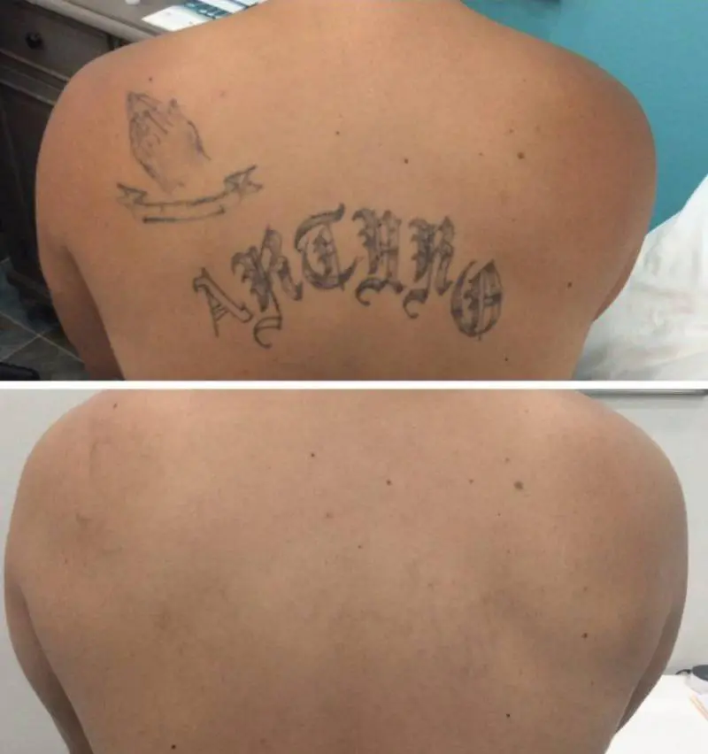 Is Laser Tattoo Removal Damaging Your Immune System or is Laser Tattoo ...