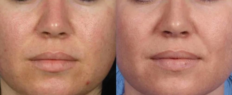 Pore Reduction Skin Treatment in Cheshire